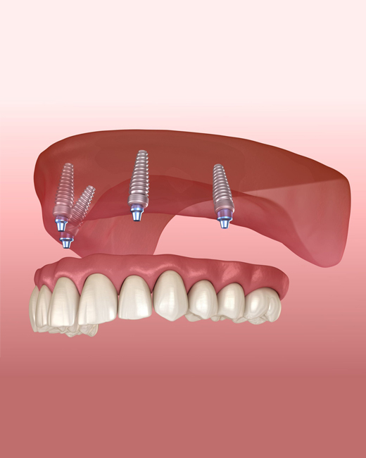 Snap-In Implant Dentures in Charlotte NC | Dentistry Of Uptown Charlotte
