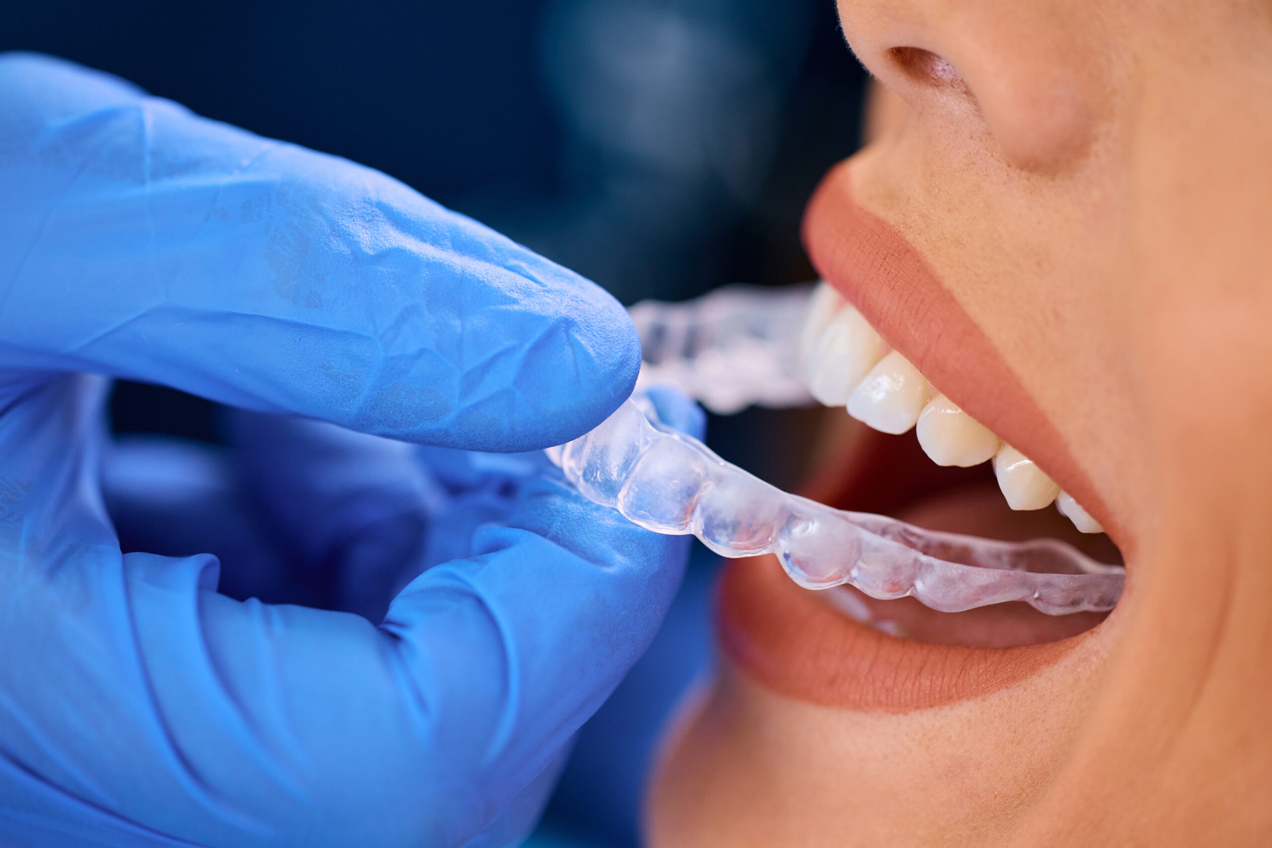 How to Properly Care for Your Invisalign Aligners