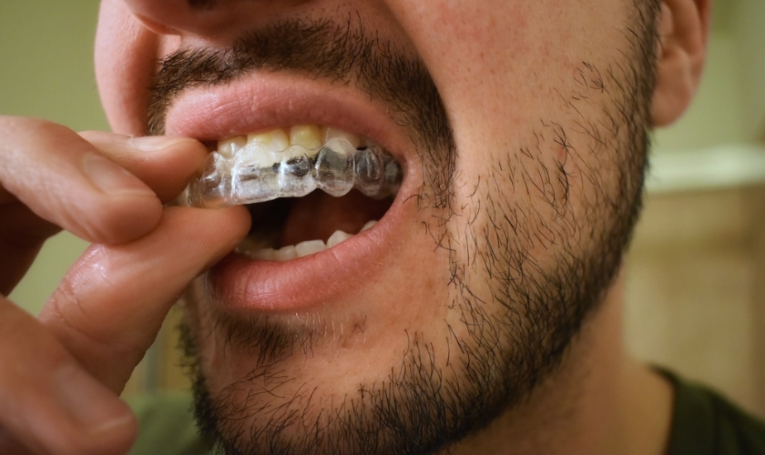 Eating with Invisalign in Charlotte: Dos and Don’ts